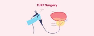 Your Recovery After TUR-P Surgery for Enlarged Prostate