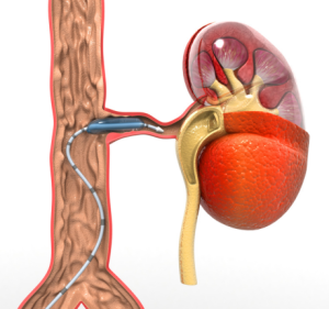 Stent Placement in URS for Kidney Stone Surgery: Tips from Dr. Anup Ramani